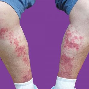 Rheumatoid Vasculitis Advice | Symptoms, Causes & More | 2024 - Pure ...