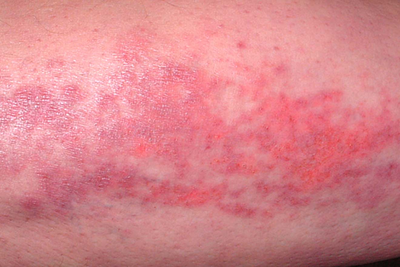 Dermatomyositis Advice | Causes Symptoms & Treatment | 2024 - Pure Medical