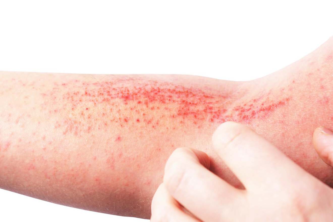 Contact Dermatitis | Symptoms, Causes, Treatment - Pure Medical