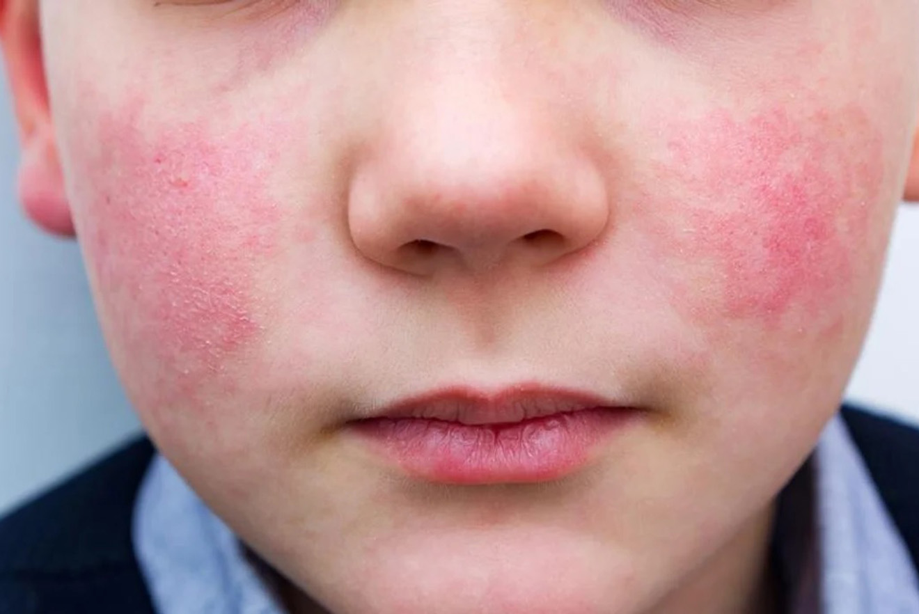 13 of the Most Common Child Skin Problems | Identify the Cause - Pure ...