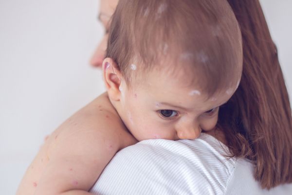 13 of the Most Common Child Skin Problems | Identify the Cause - Pure ...