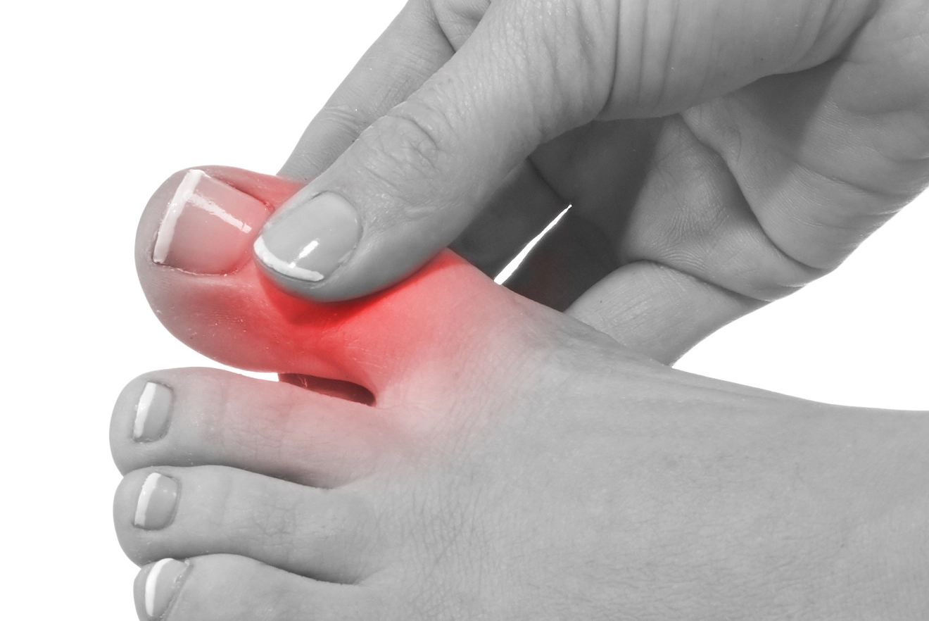 Gout Treatment UK | 2024 - Pure Medical