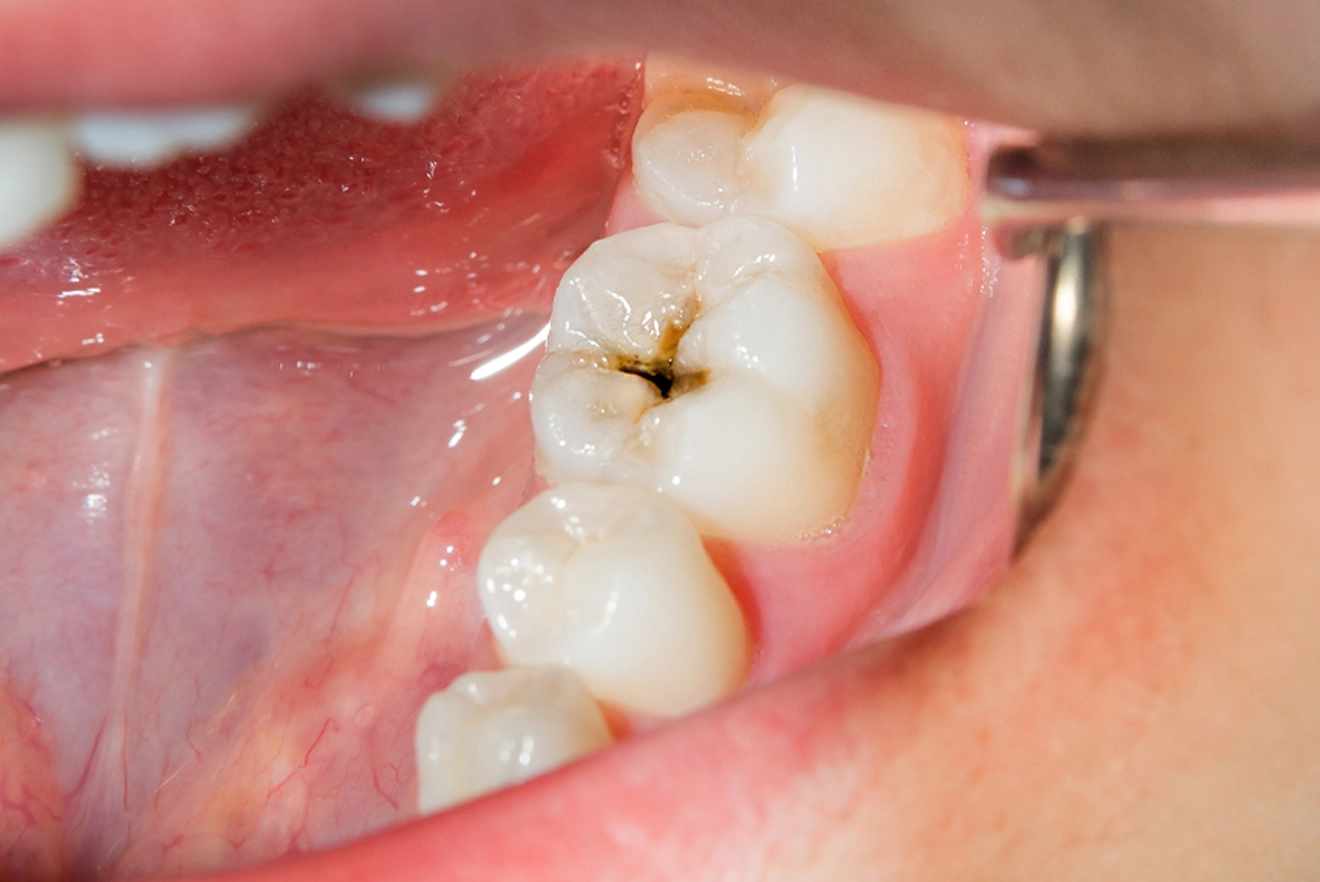 Cavities In Teeth | Signs, Causes, and Remedies - Pure Medical