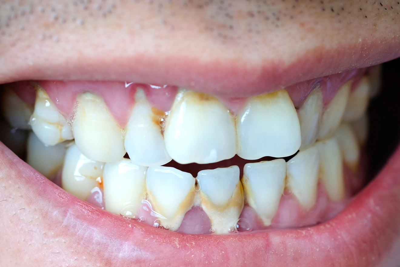 Smoking and Oral Health | Bad Breath, Yellow Teeth & More - Pure Medical