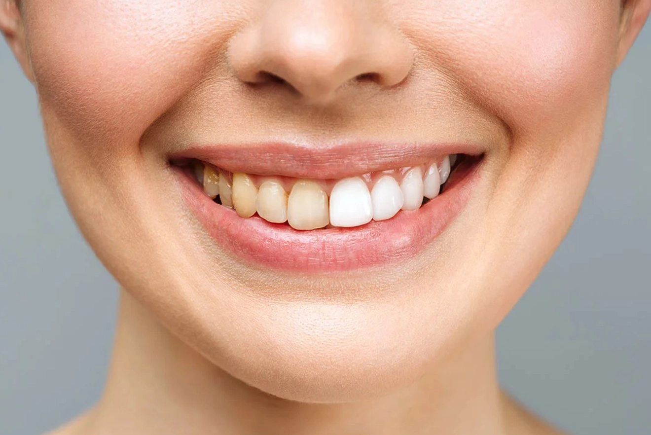 Tooth discolouration | Types, Causes, Treatment & More - Pure Medical