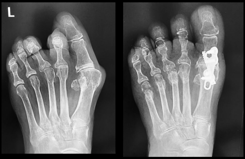 Hallux Rigidus (Stiff Big Toe) | Symptoms, Causes & Treatment - Pure ...